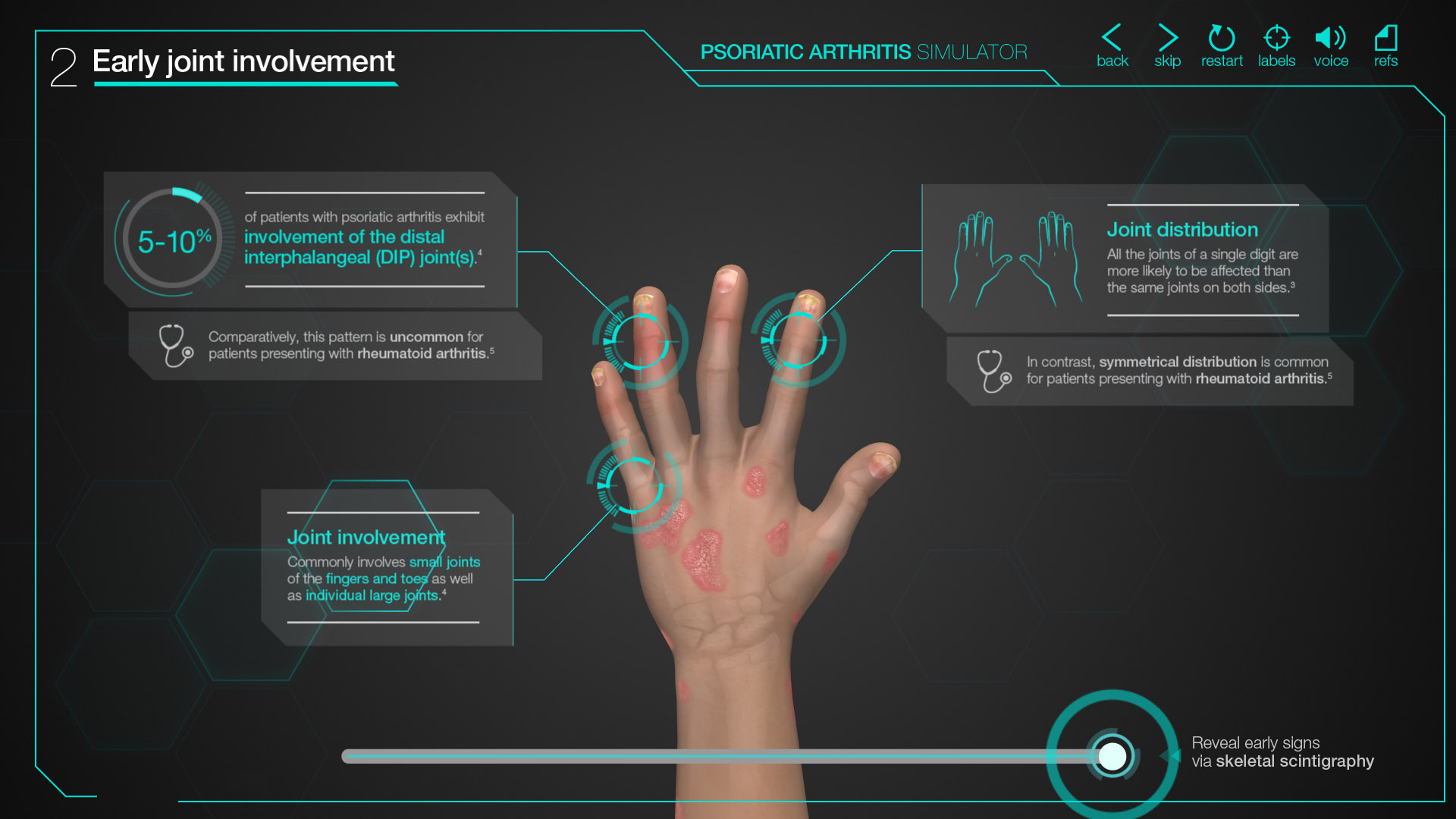 Medical AR: Psoriatic Arthritis Simulator | Medical Animation ...