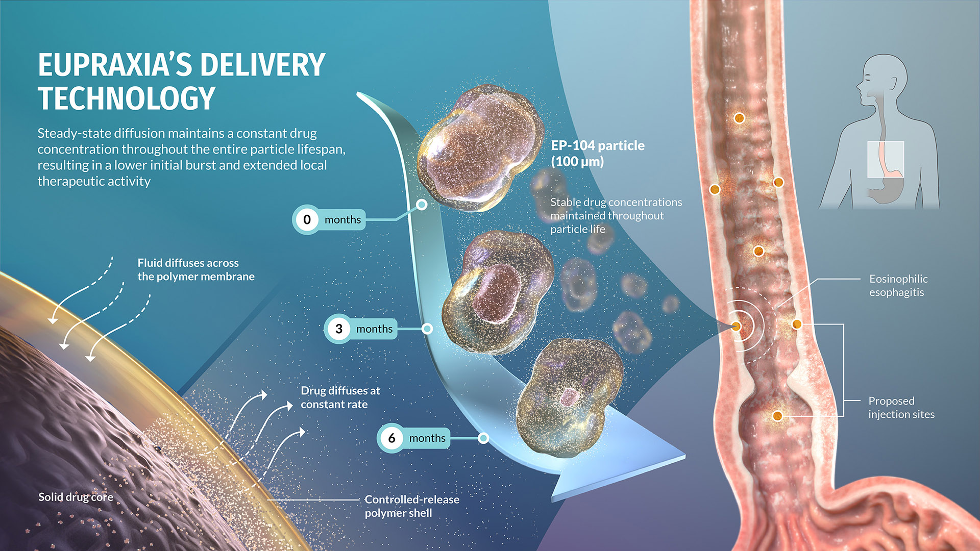 Medical illustration: Analgesic Drug Delivery for Osteoarthritis - AXS ...