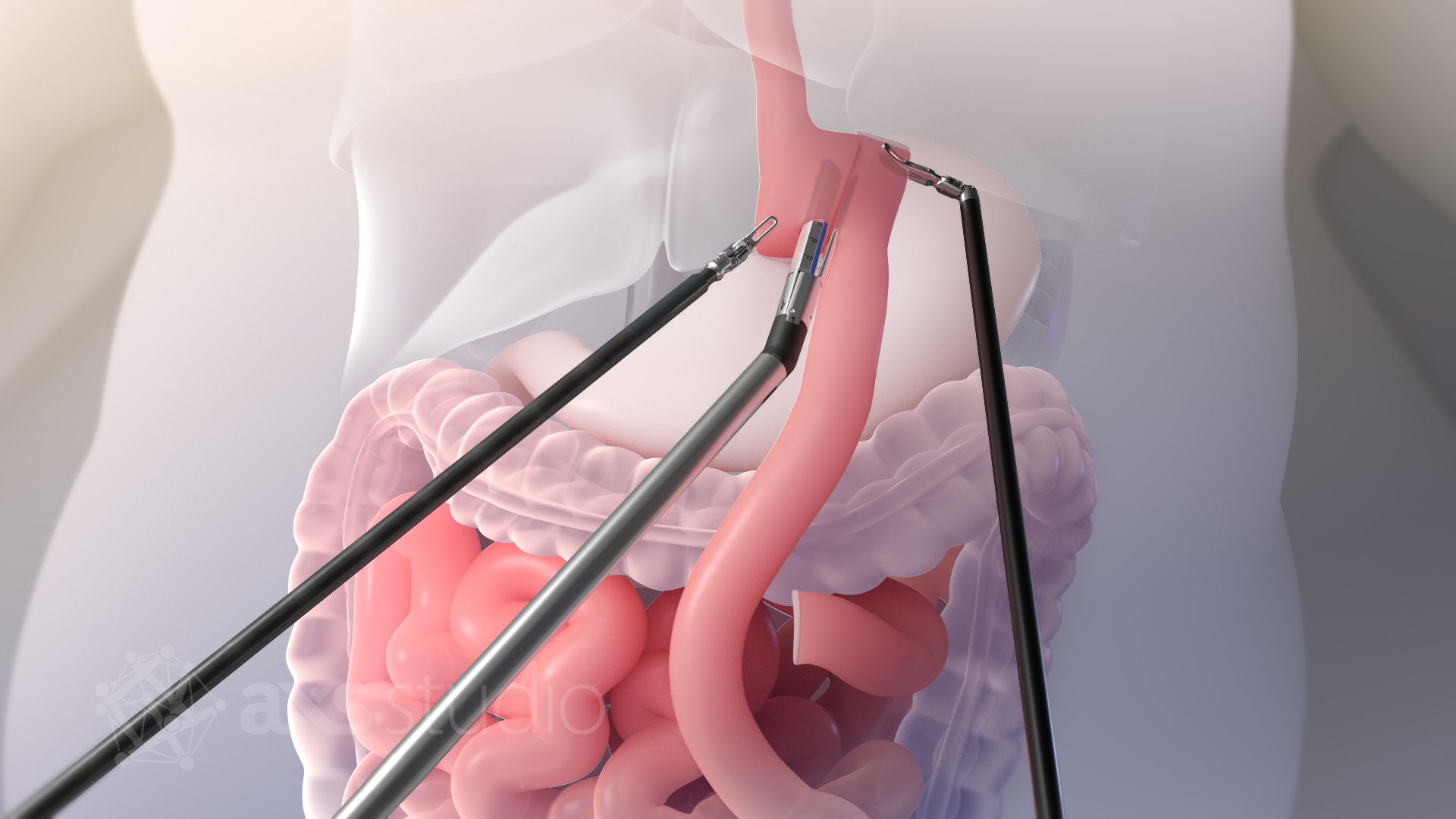 Medical Device Animation: Robotic-Assisted Surgery - AXS Studio